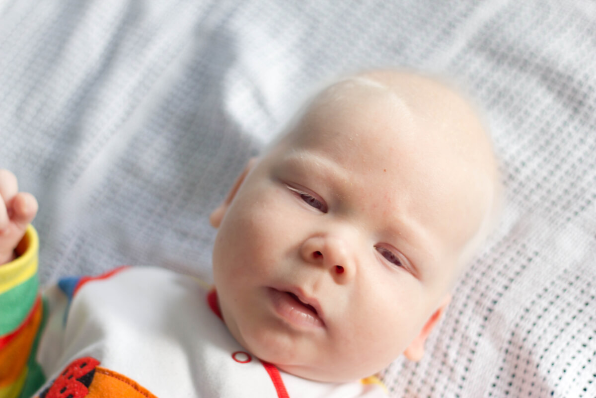 What Is Albinism?
