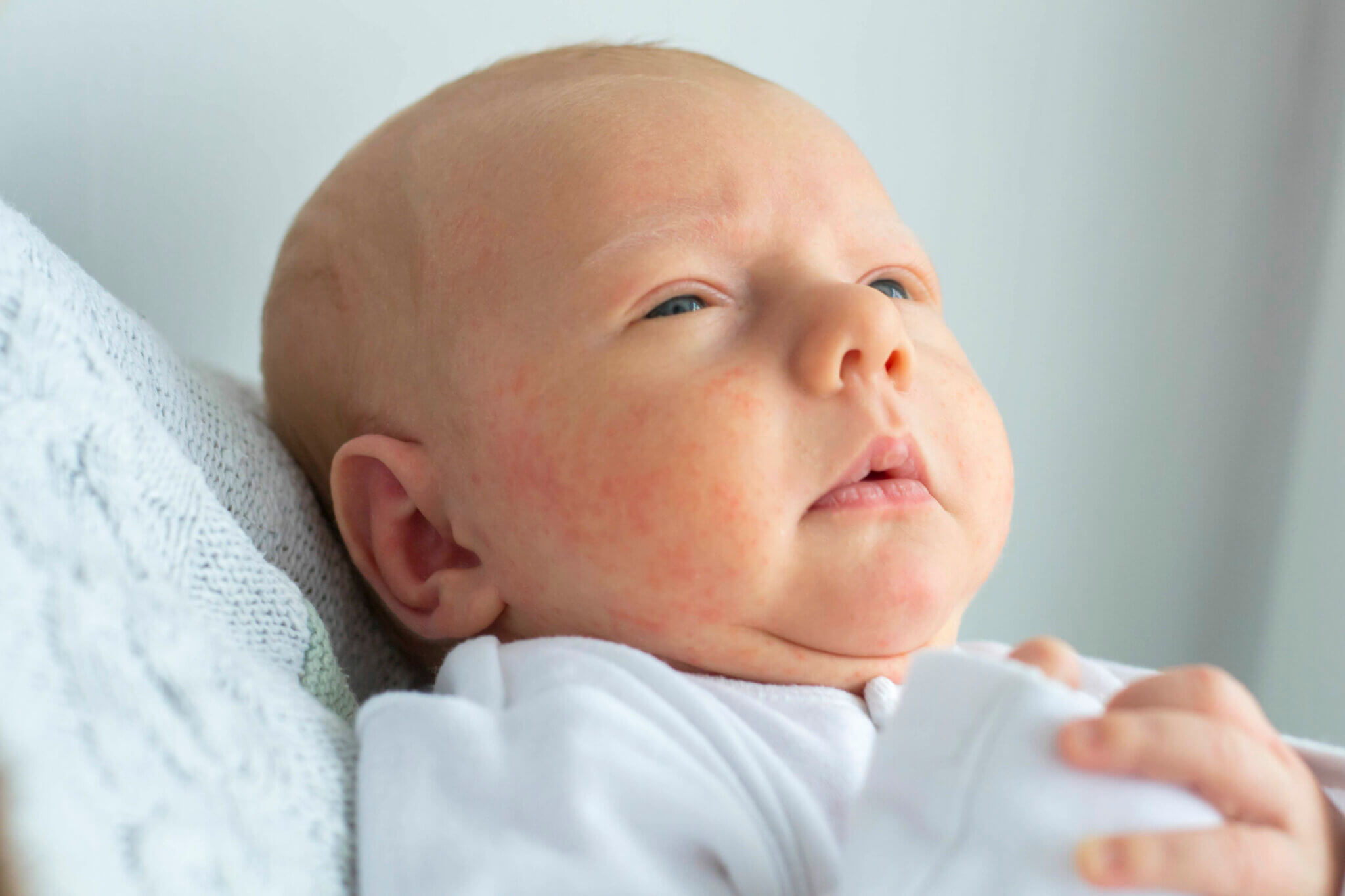 Eczema in babies: everything you need to know