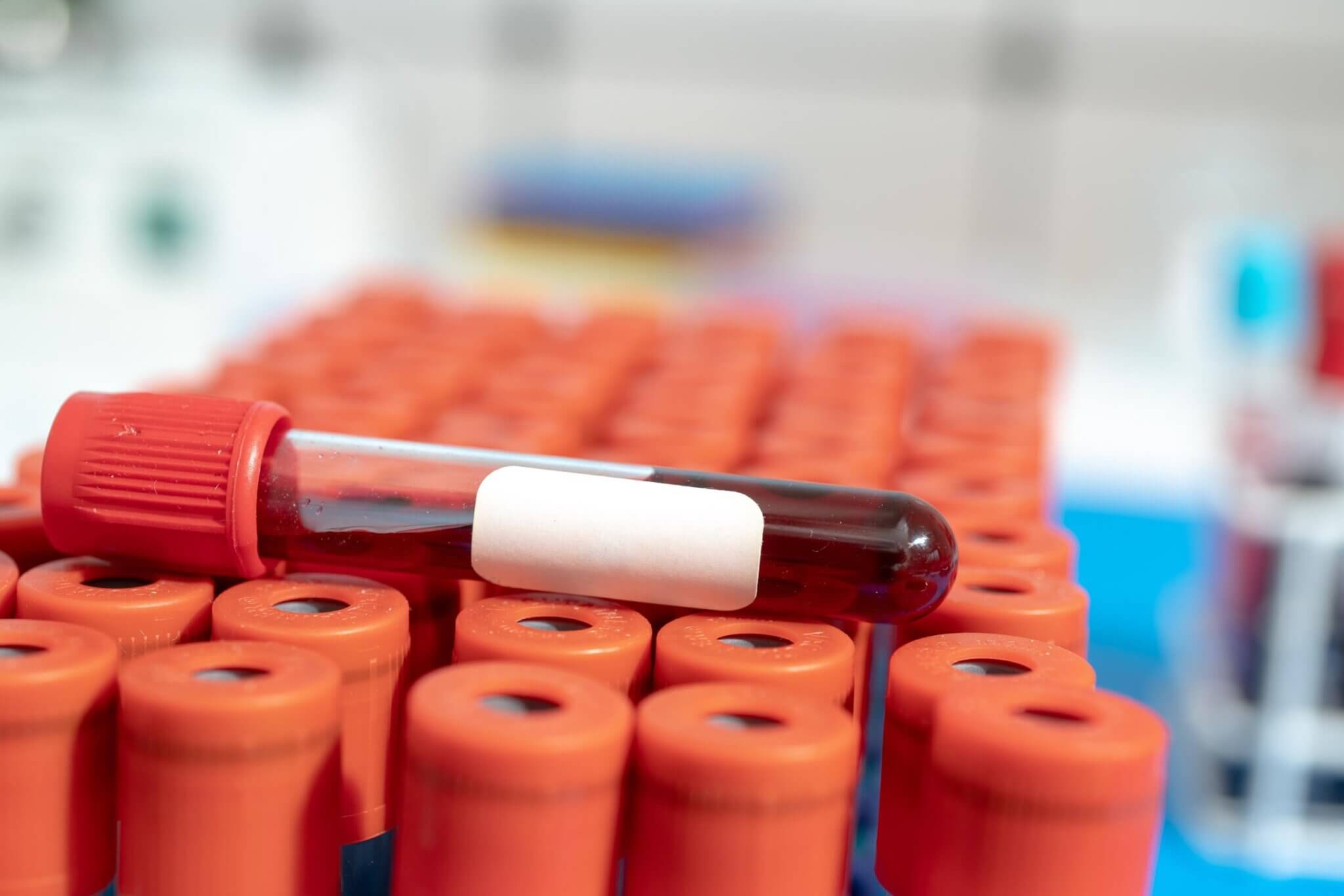 Diabetes tipo 3C: lo que debes saber - Muy Salud