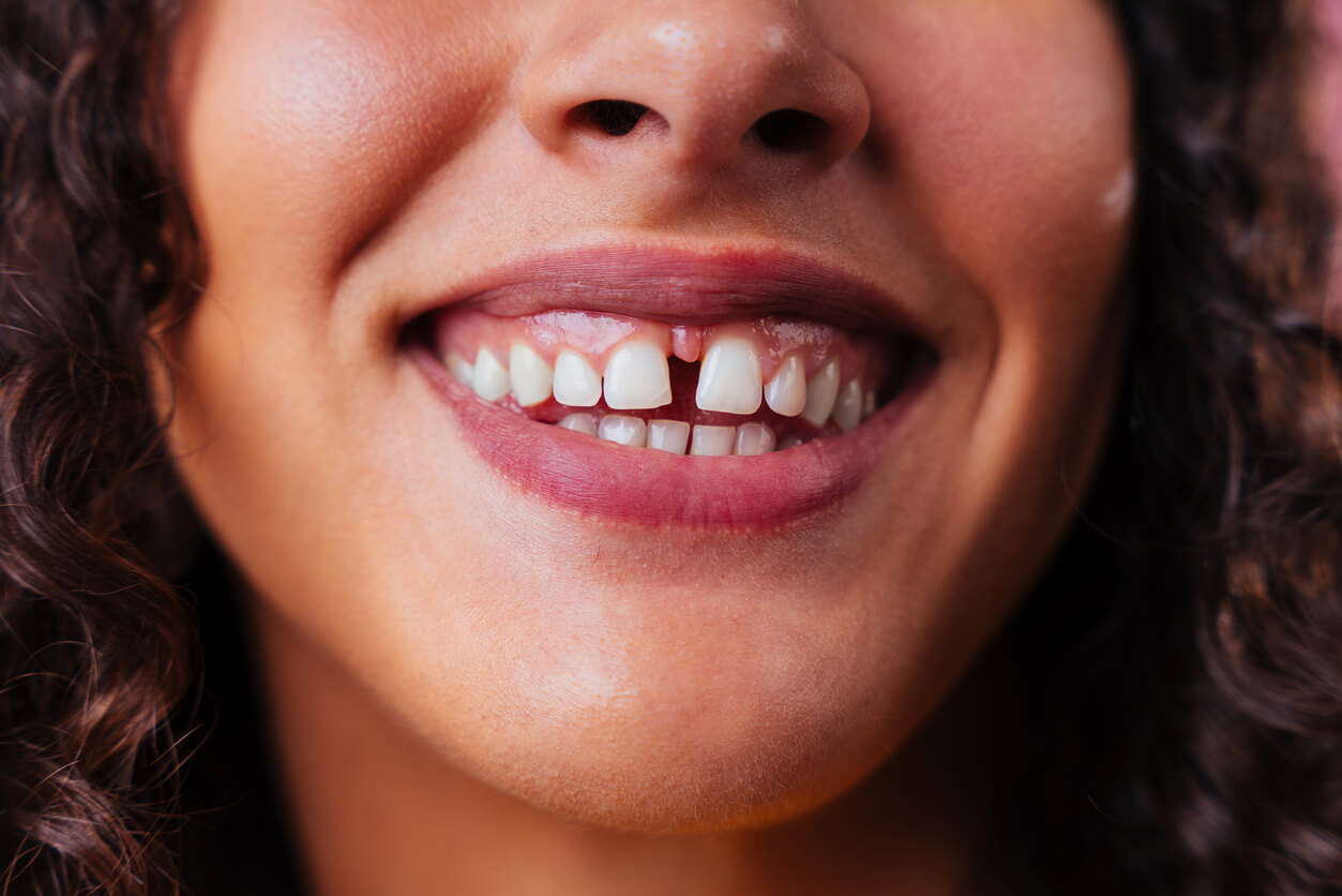 Diastema: por qué mis dientes se separan y cómo corregirlo - Muy Salud